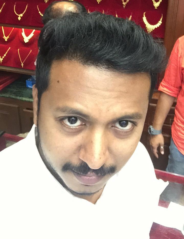 Results - Nano Hair Transplant